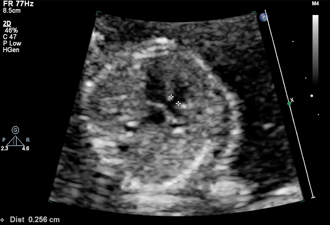 Ventricular septal defect on Fetal echo – Fetal Cardiac Care