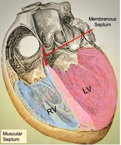 Ventricular septal defect on Fetal echo – Fetal Cardiac Care