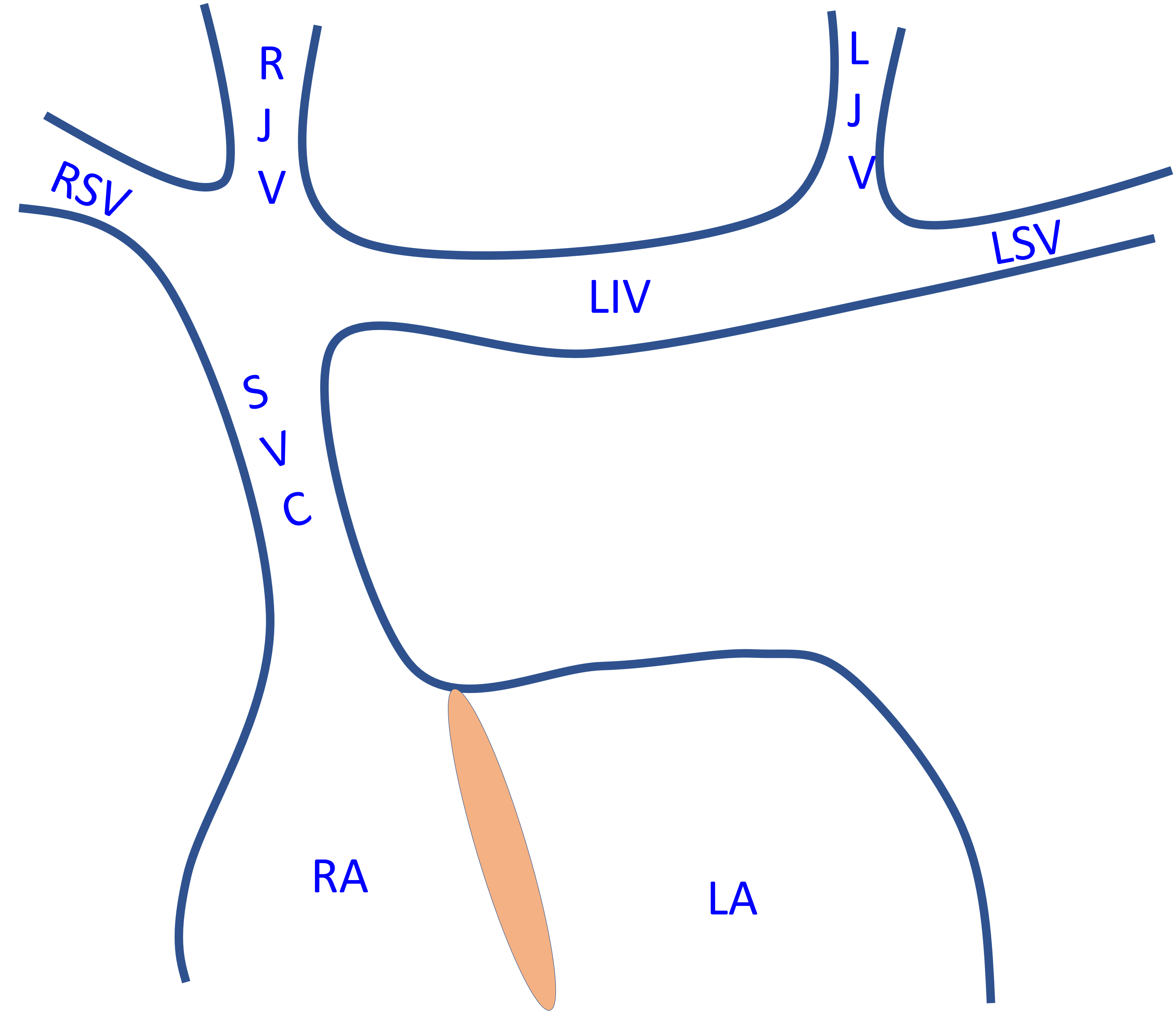 Persistent Left Superior Vena Cava (PLSVC) – Fetal Cardiac Care