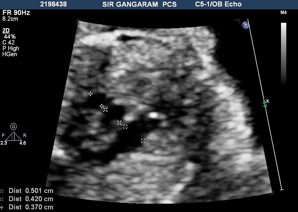 Fetal Coarctation of Aorta: Predicting the Unpredictable. – Fetal ...