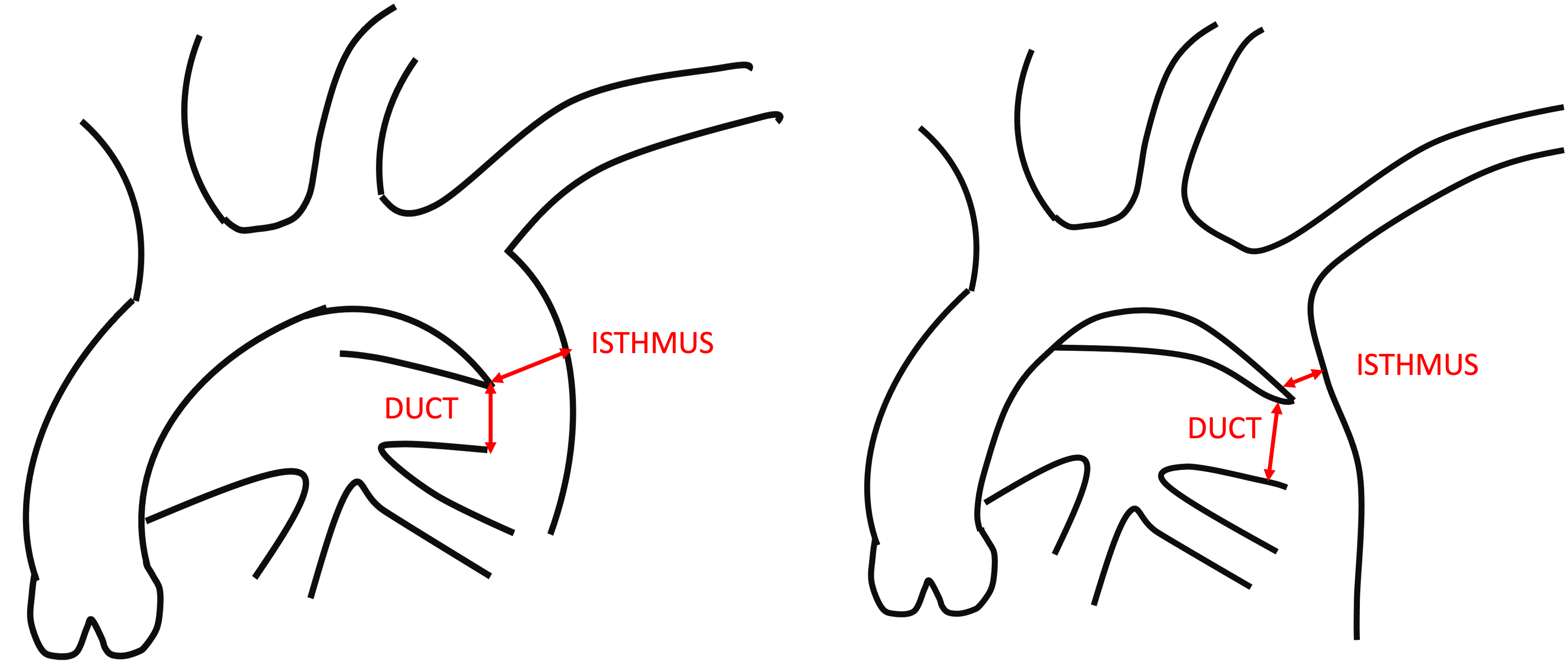 Fetal Coarctation of Aorta: Predicting the Unpredictable. – Fetal ...