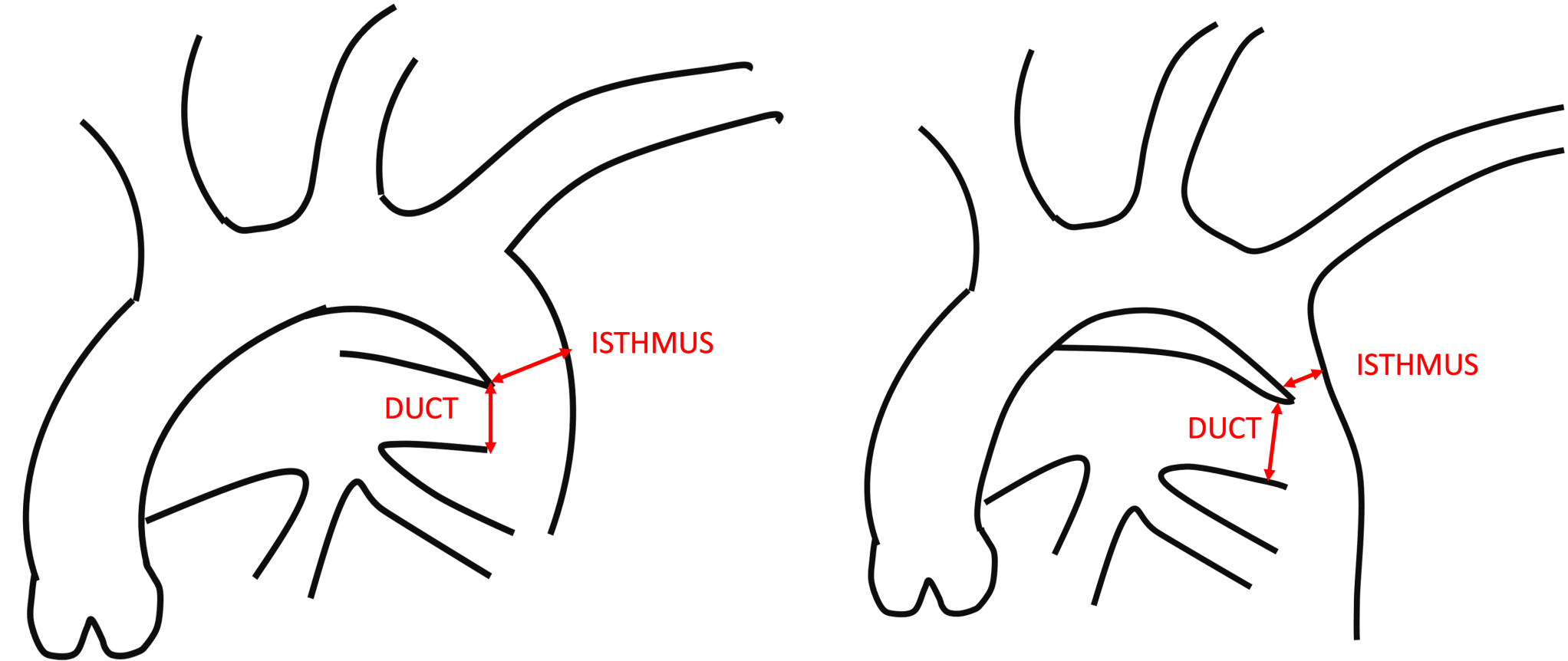 Fetal Coarctation of Aorta: Predicting the Unpredictable. – Fetal ...