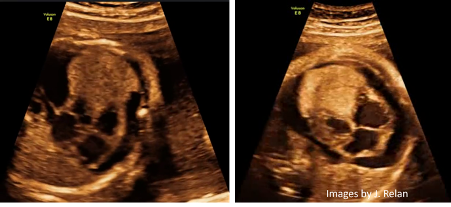 Fetal Pericardial Effusion: A Review of Current Diagnostic and ...