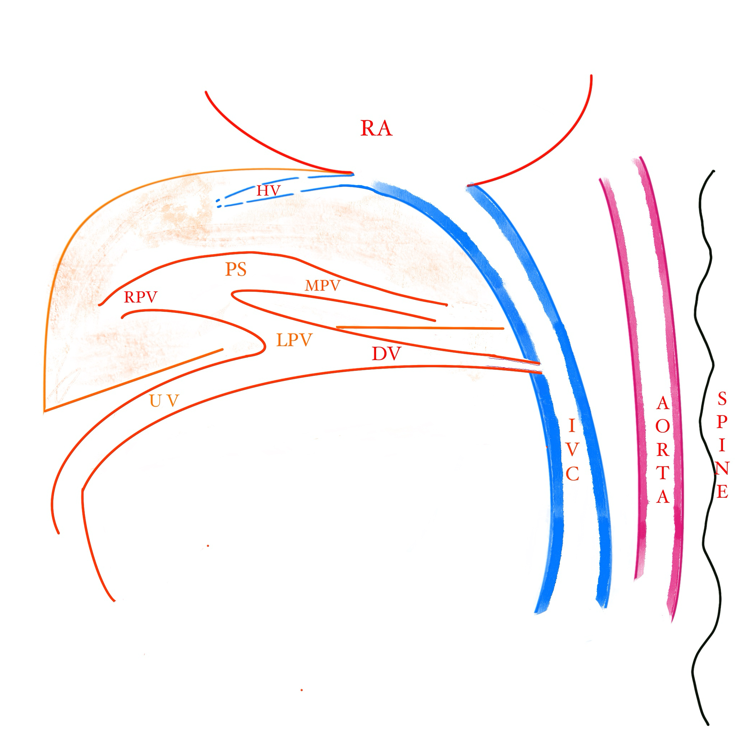 Fetal Umbilical–Portal–Systemic Venous Shunt – Fetal Cardiac Care