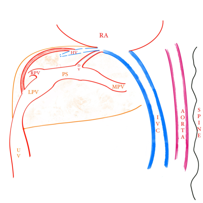 Fetal Umbilical–Portal–Systemic Venous Shunt – Fetal Cardiac Care