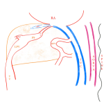 Fetal Umbilical–Portal–Systemic Venous Shunt – Fetal Cardiac Care