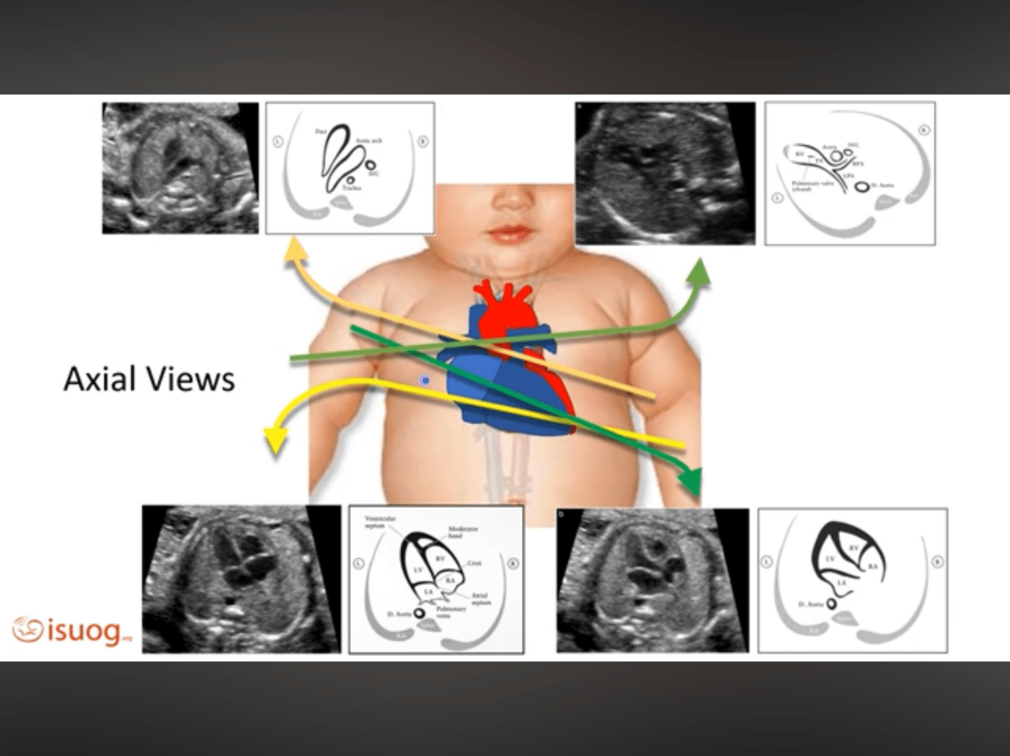 Exploring the V, U, and Y of the VT3 View – Fetal Cardiac Care