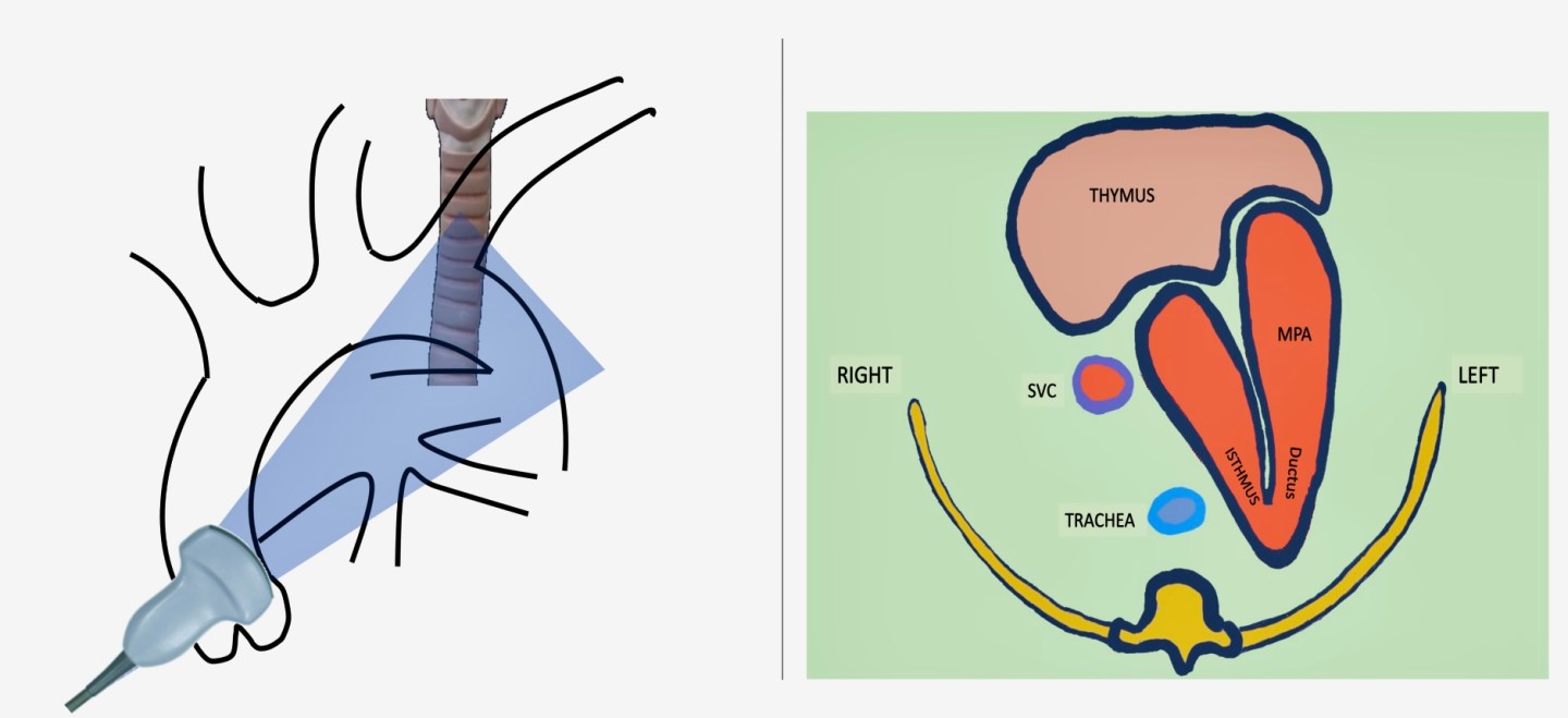 Exploring the V, U, and Y of the VT3 View – Fetal Cardiac Care