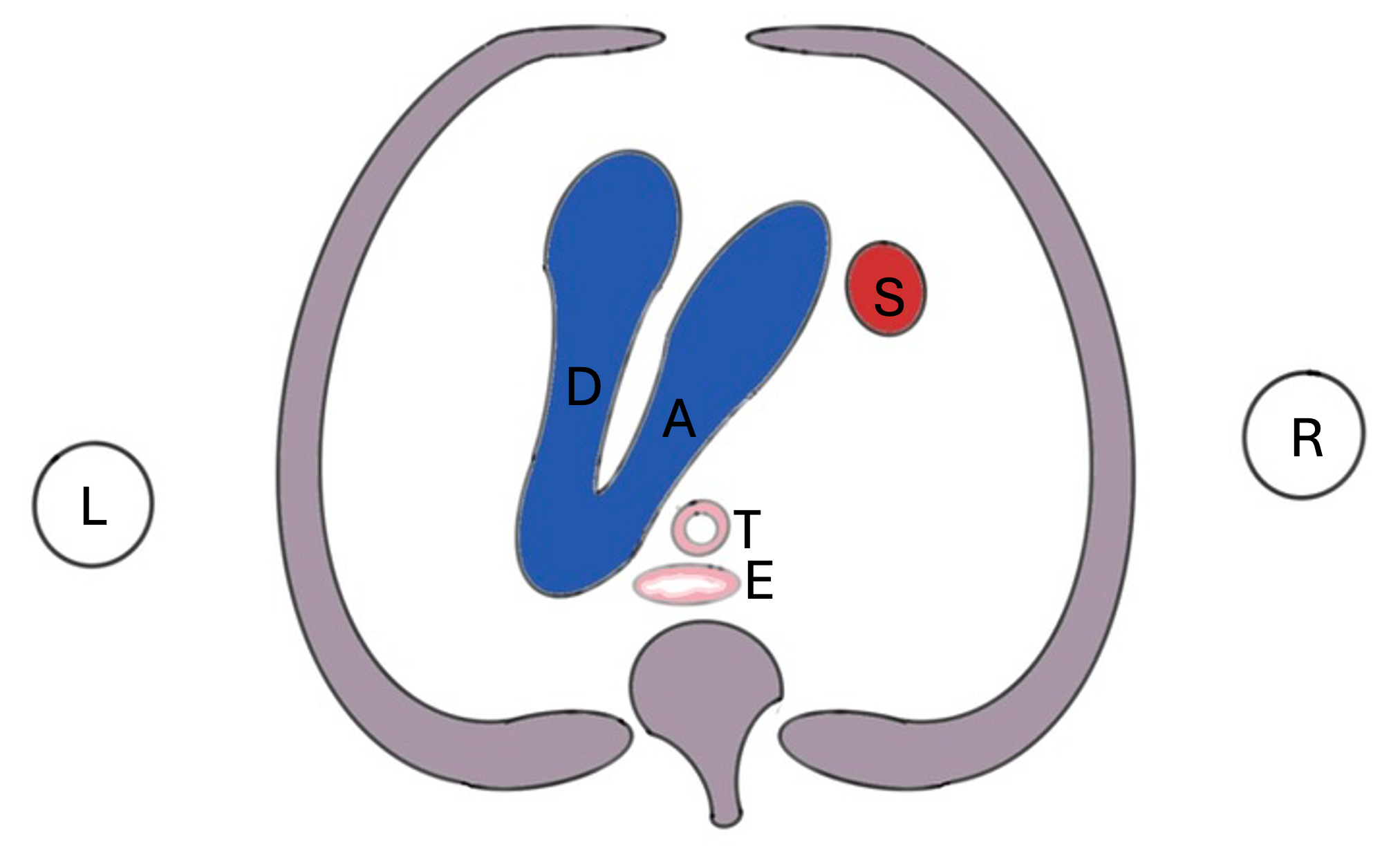 Exploring the V, U, and Y of the VT3 View – Fetal Cardiac Care