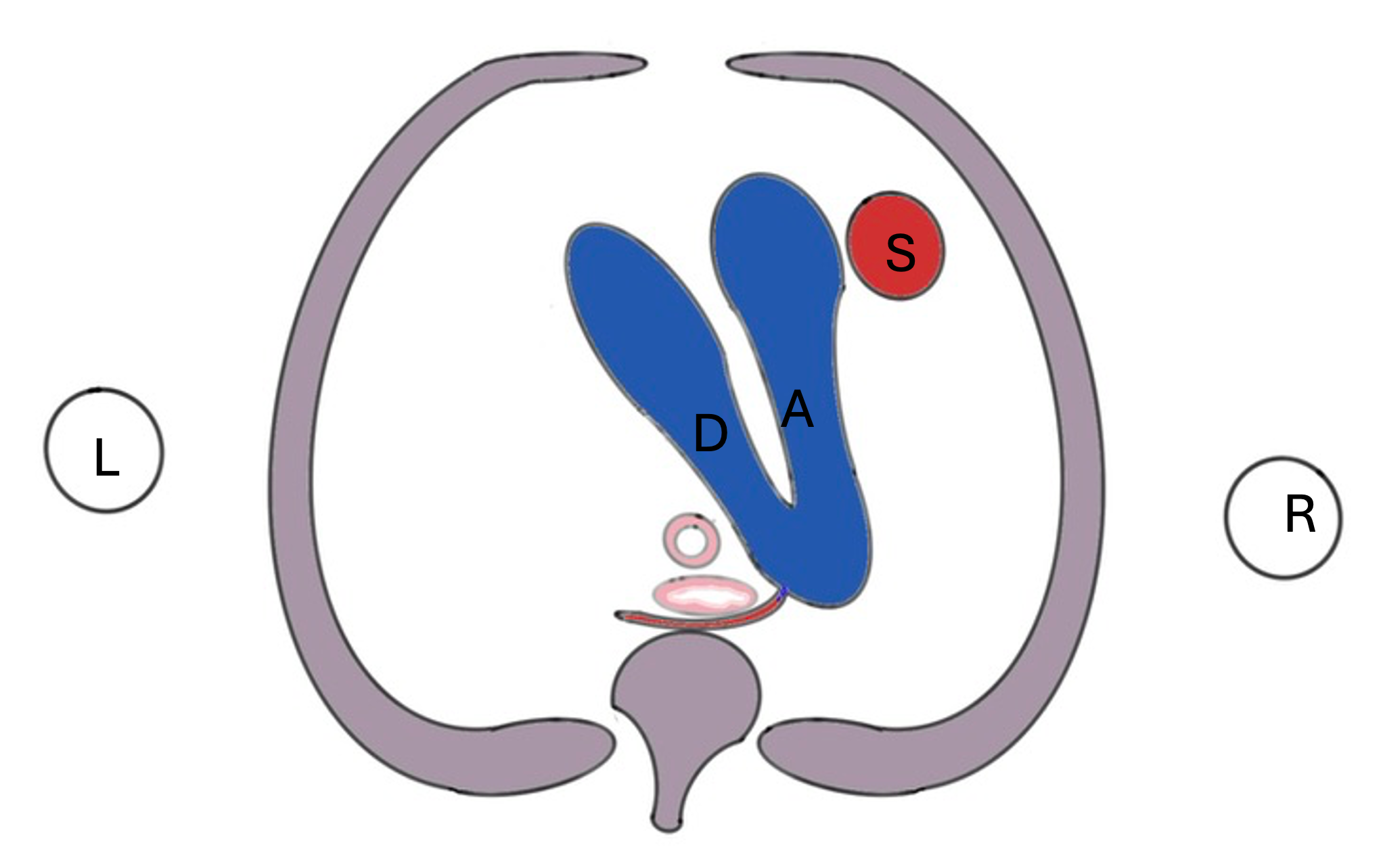 Exploring the V, U, and Y of the VT3 View – Fetal Cardiac Care