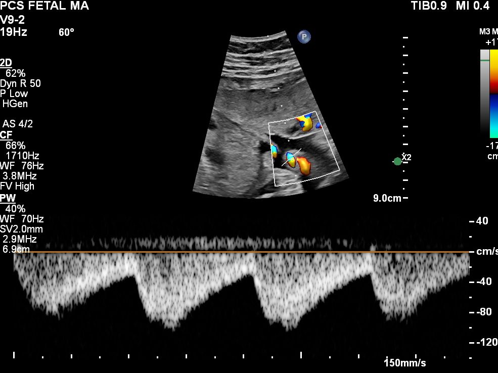 CVPS and CPR: A Tale of Two Essential Scores for Fetal Cardio-Placental ...