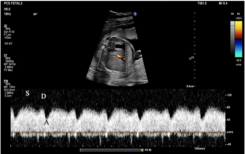 Ductus Venosus Waveform Analysis: A Critical Tool for Assessing Fetal ...