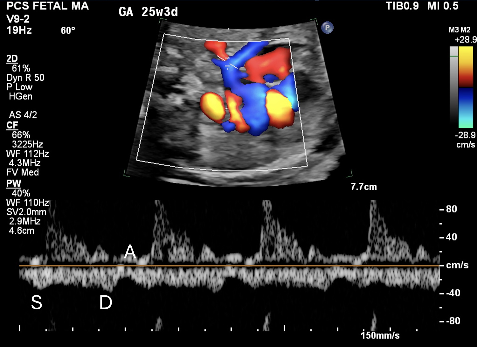 Spotting Fetal TAPVC Made Simple: A Diagnostic Roadmap – Fetal Cardiac Care