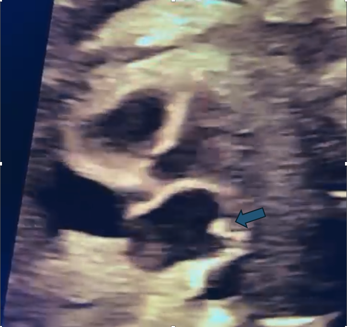 Spotting Fetal TAPVC Made Simple: A Diagnostic Roadmap – Fetal Cardiac Care