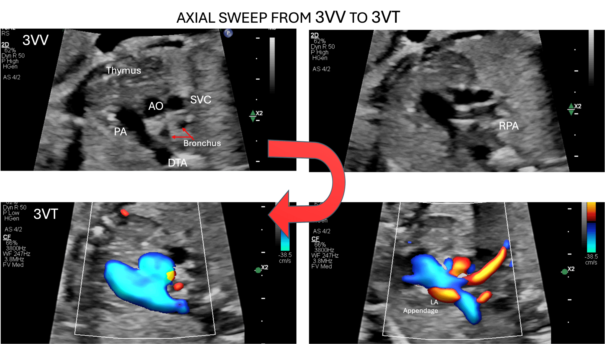 Fetal Branch Pulmonary Artery Doppler: Technique, Interpretation, and ...