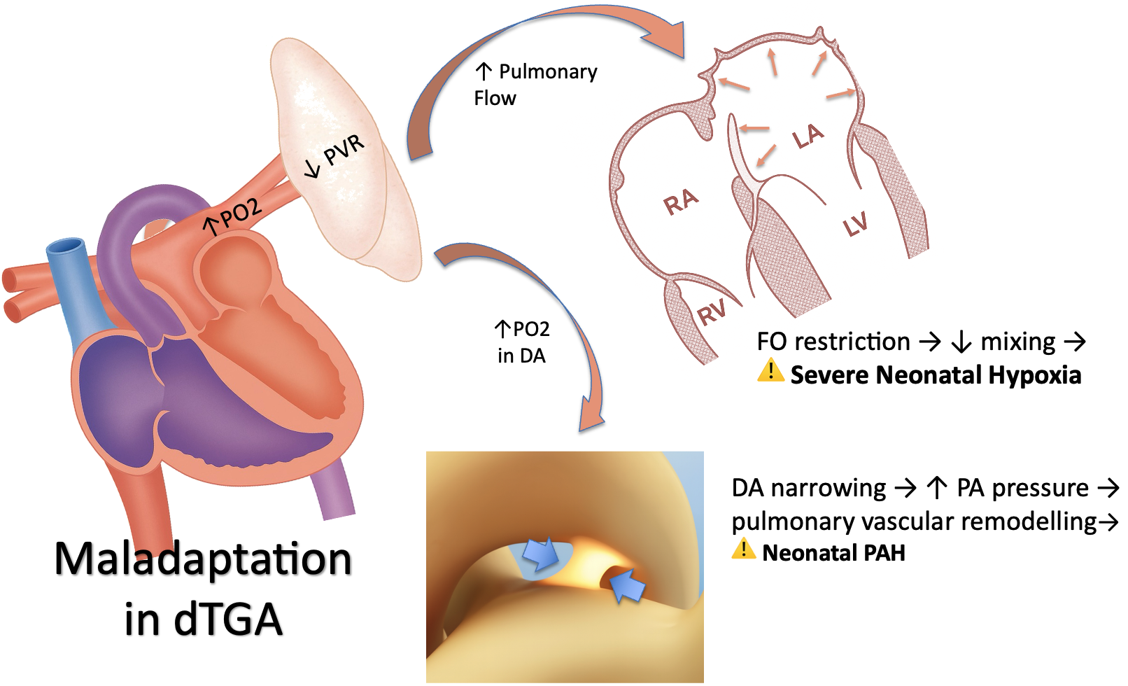 Fetal d-TGA: Counselling & Assessment Beyond Diagnosis – Fetal Cardiac Care