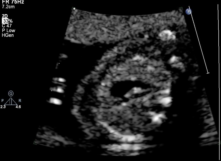 Fetal Echocardiography in TOF: Risk Stratification and Perinatal ...