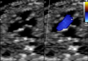 Fetal Echocardiography in TOF: Risk Stratification and Perinatal ...