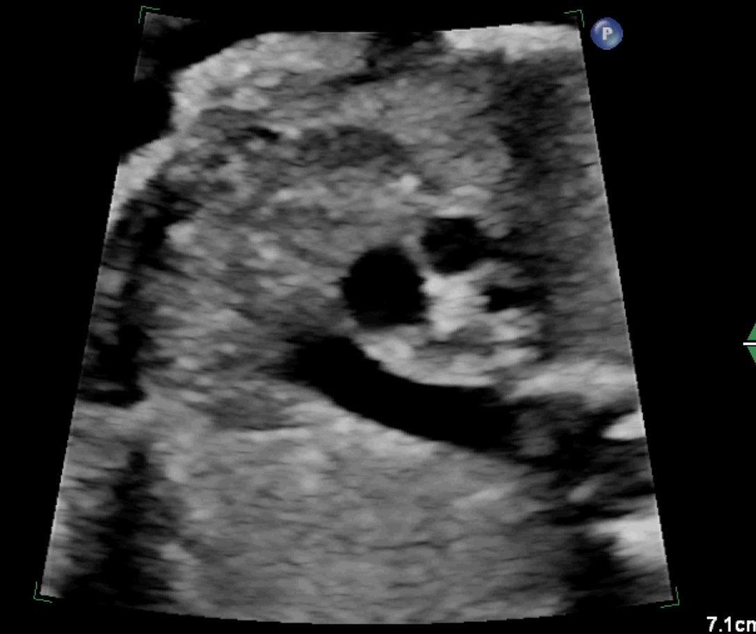 Fetal Echocardiography in TOF: Risk Stratification and Perinatal ...