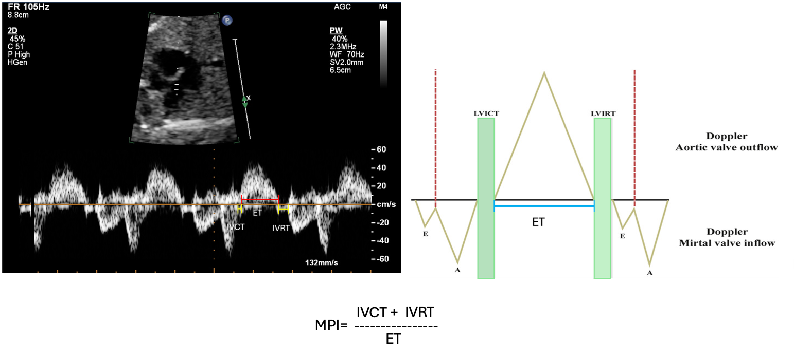 MPI in Fetal Echocardiography: From Numbers to Clinical Insight – Fetal ...