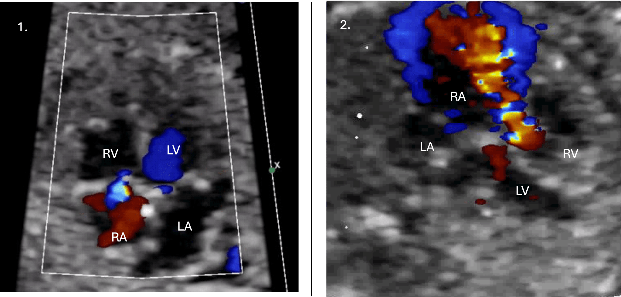 Isolated Tricuspid Regurgitation in the Fetus: From Screening to Fetal ...